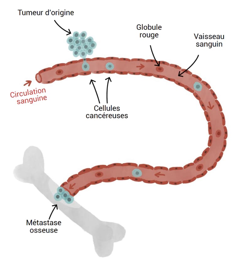 Prise en charge des métastases osseuses | Cancer supporters.fr